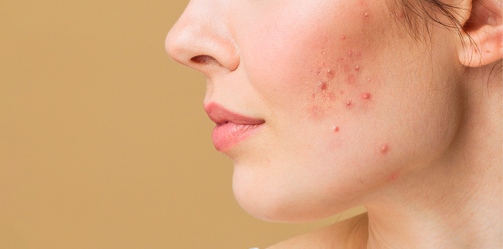 Causas del acne en las mejillas - Enfermería Clínica