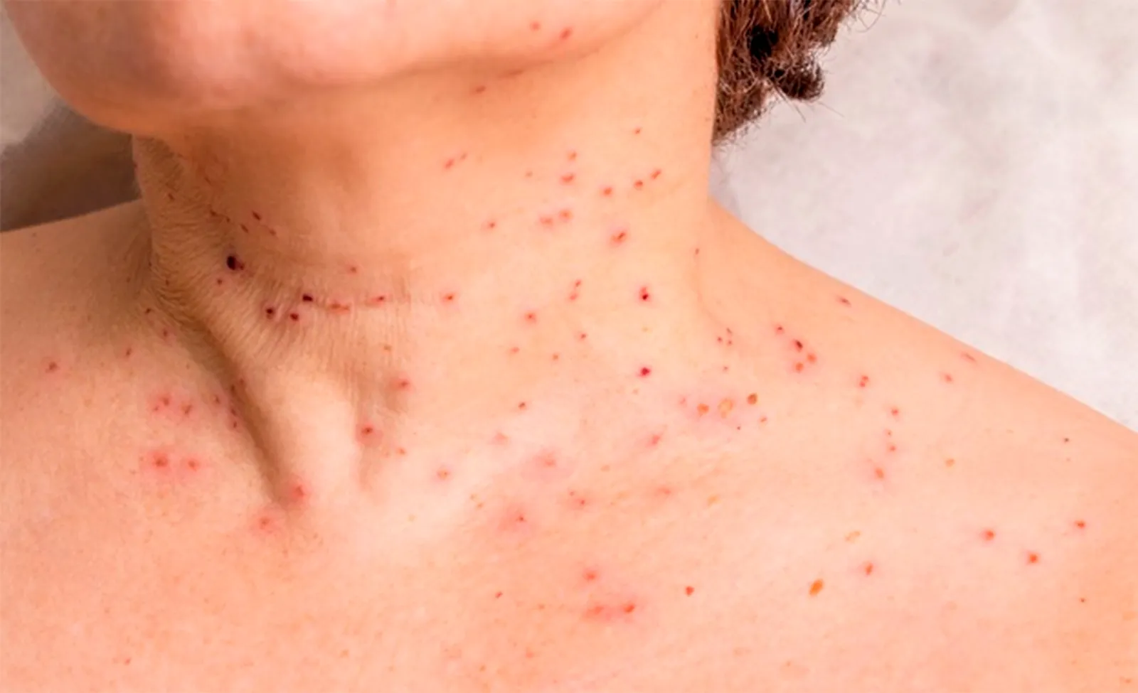 Papiloma Humano - Enfermería Clínica