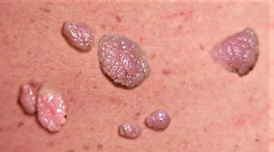 Virus del Papiloma Humano - Enfermería Clínica