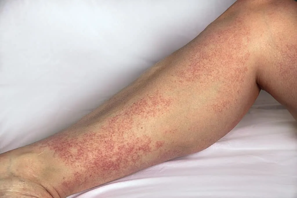 Vasculitis - Enfermería Clínica