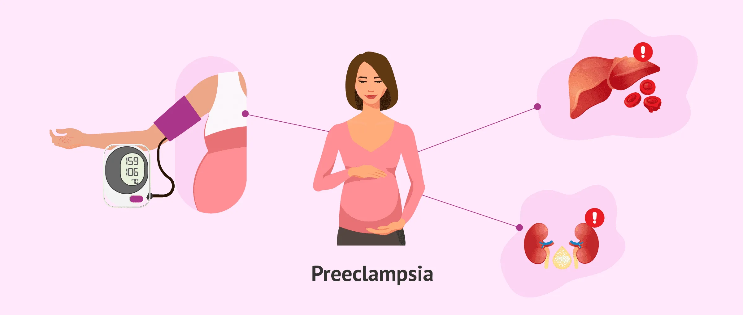Preeclampsia - Enfermería Clínica